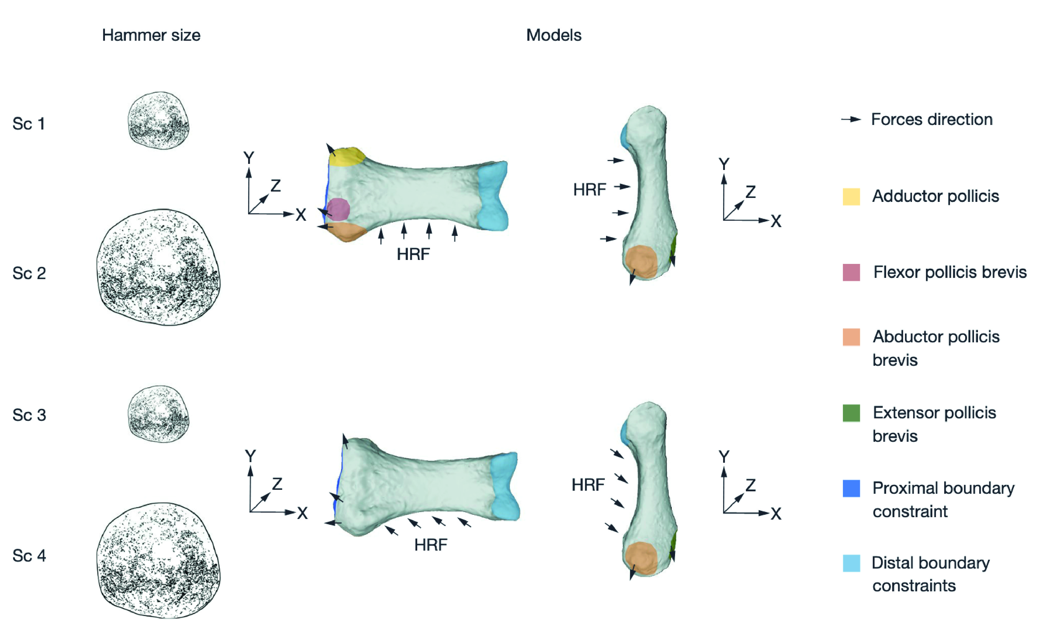 Finite element analysis of the proximal phalanx of the thumb in ...
